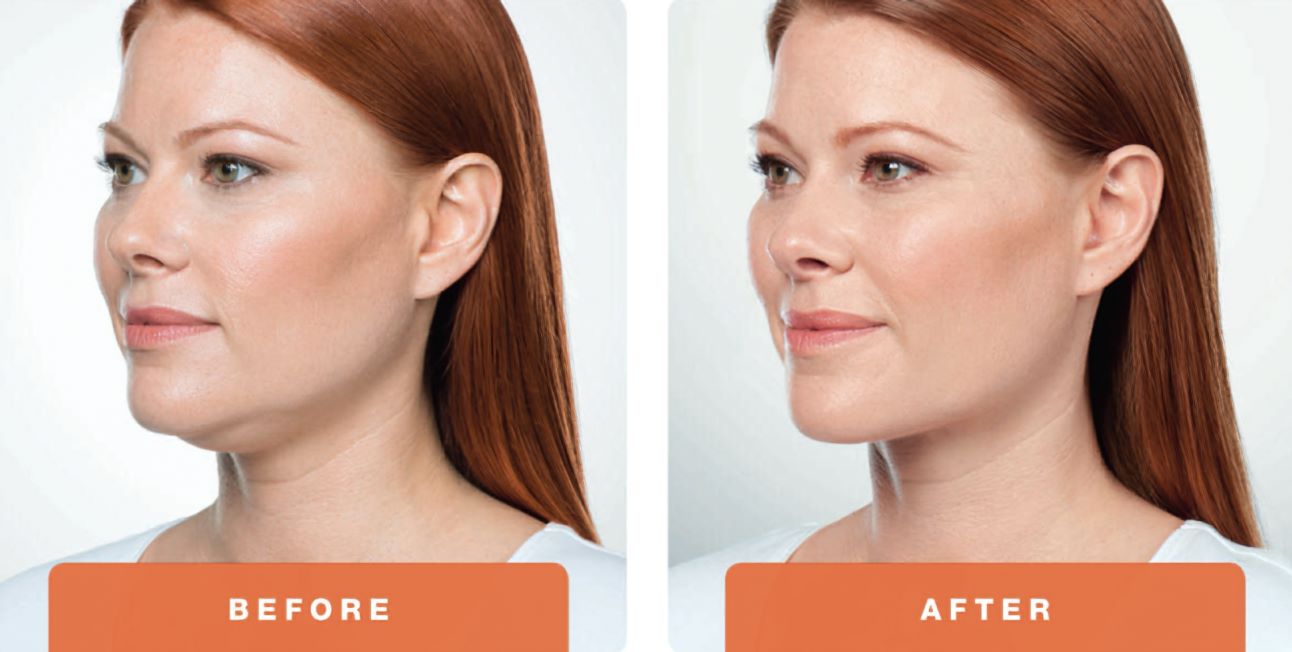Belkyra® The Treatment For A Double Chin - Louise Highet